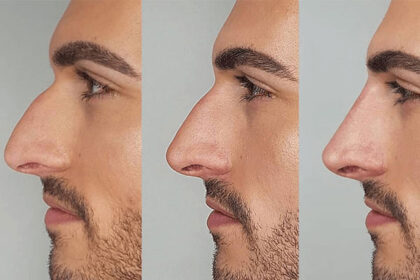 Non-surgical Rhinoplasty (Nose Job) - Eternal Beauty Medical Centre